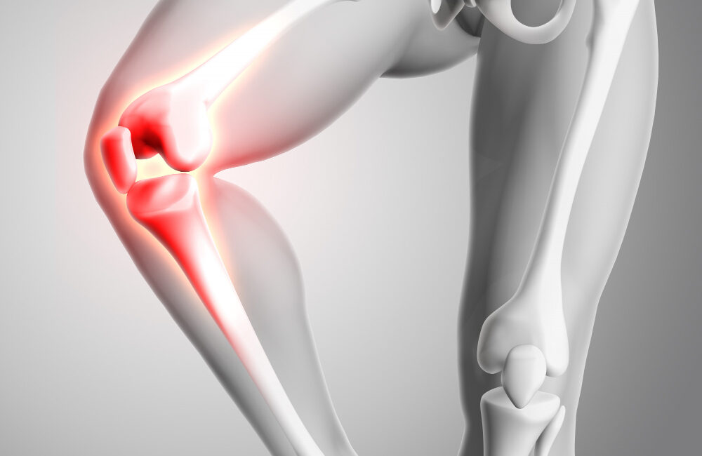 Entendendo a Artrose: Causas, Sintomas, Diagnóstico e Tratamento – Liga ...
